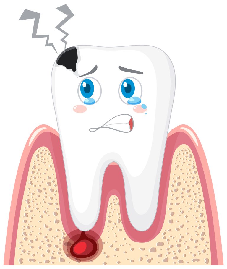 What Are the Early Symptoms of Tooth Decay?