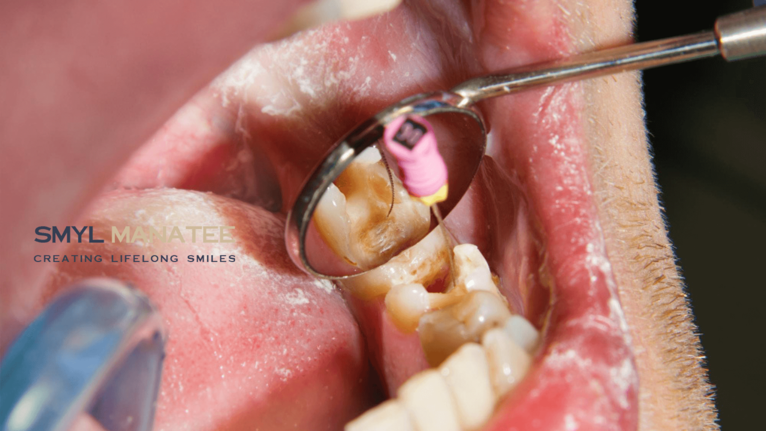 Cavity Filling Procedure: A Step-by-Step Guide
